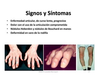 Osteoartrosis | PPTX