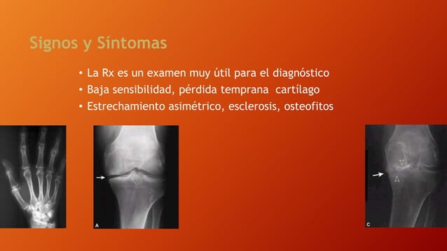 Osteoartrosis | PPTX | Bone and Joint Conditions | Diseases and Conditions