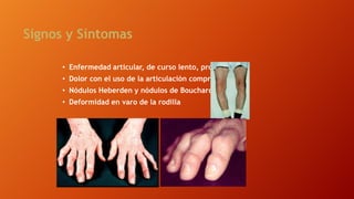 Osteoartrosis | PPTX