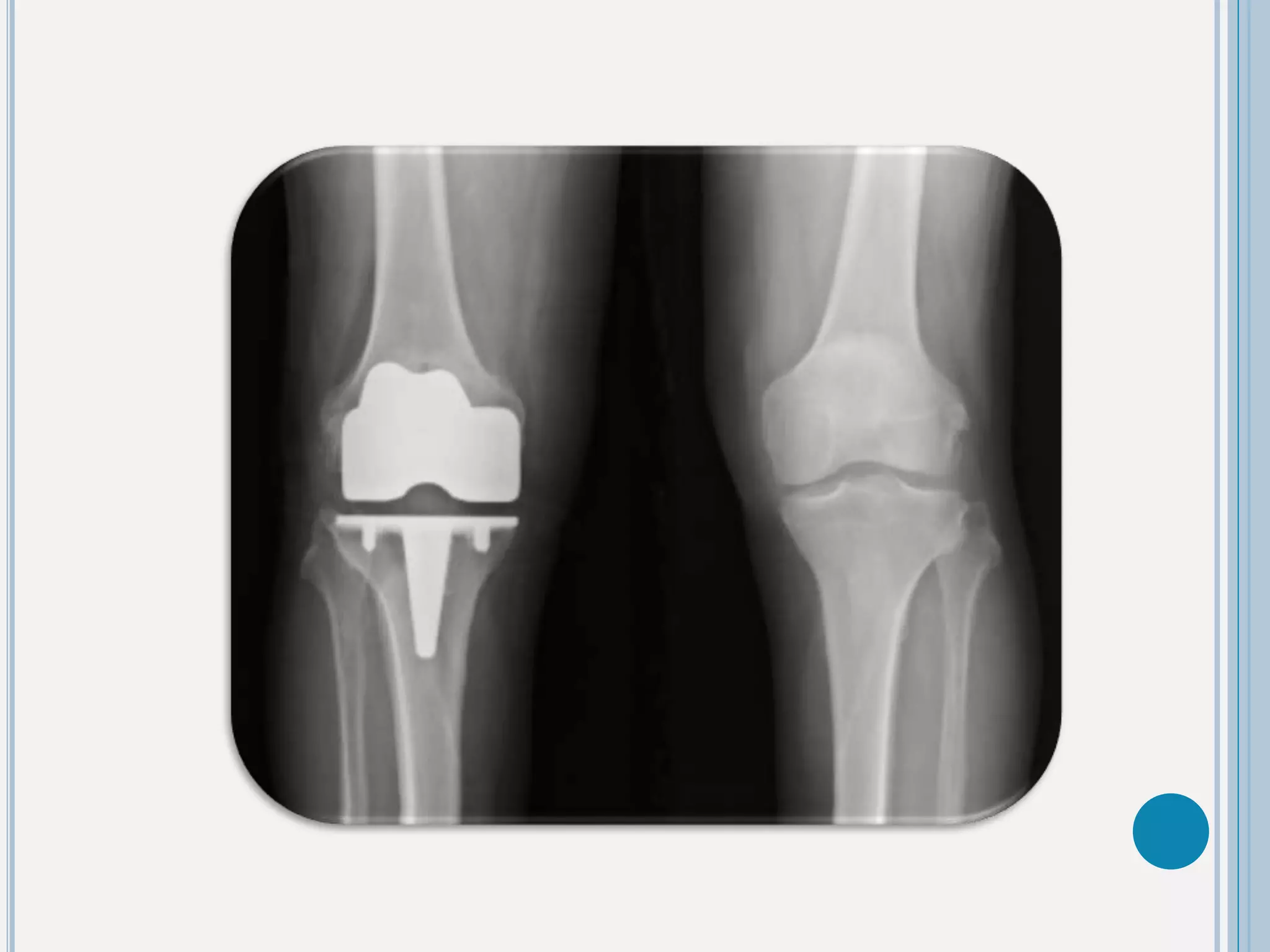 Osteoartrosis | PPT
