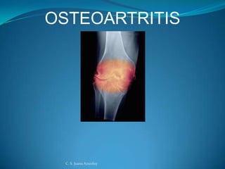 Osteoartrosis | PPTX