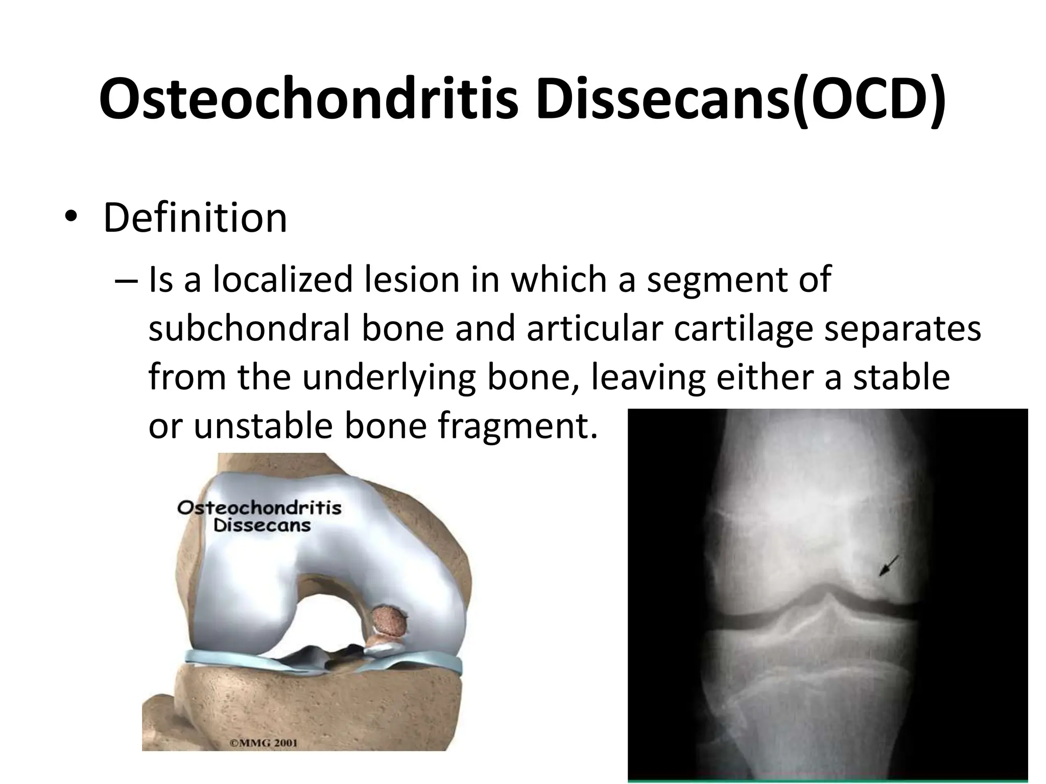 Osteochondritis by a resident presentation seminar | PPTX