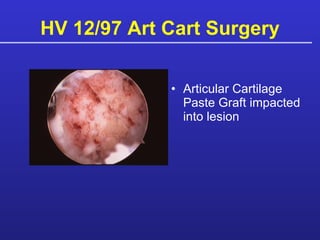 Osteochondritis dissecans | PPT