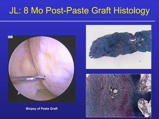Osteochondritis dissecans | PPT