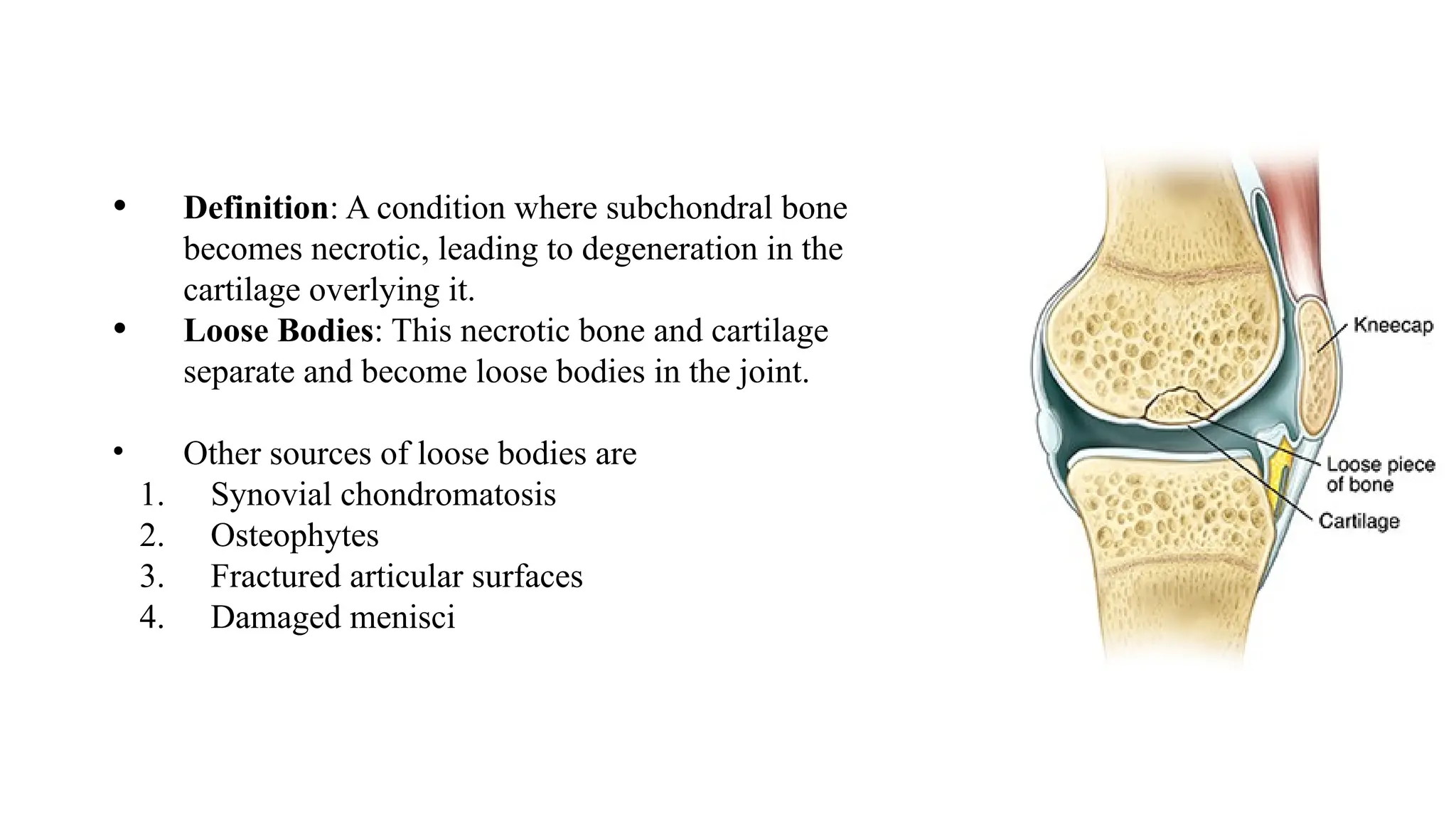 osteochondritis dissecans knee joint.pptx