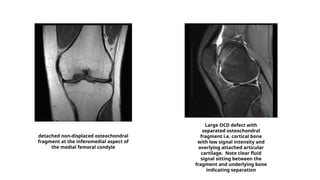 osteochondritis dissecans knee joint.pptx