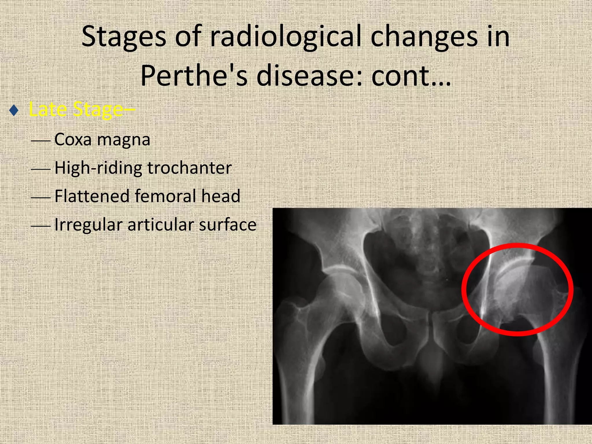 Osteochondritis of different bones | PPTX