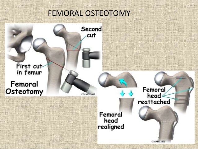 Osteochondritis of different bones