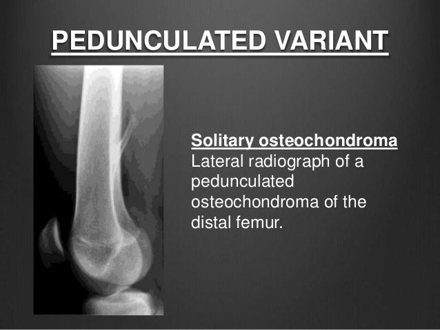 Osteochondroma