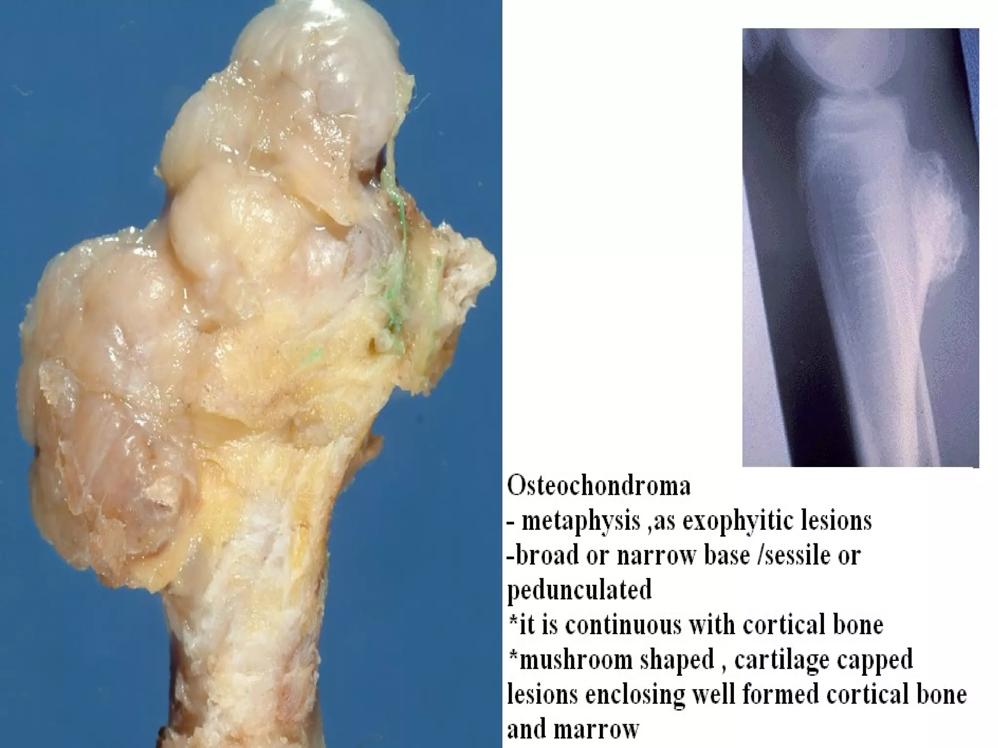 Osteochondroma | PPT