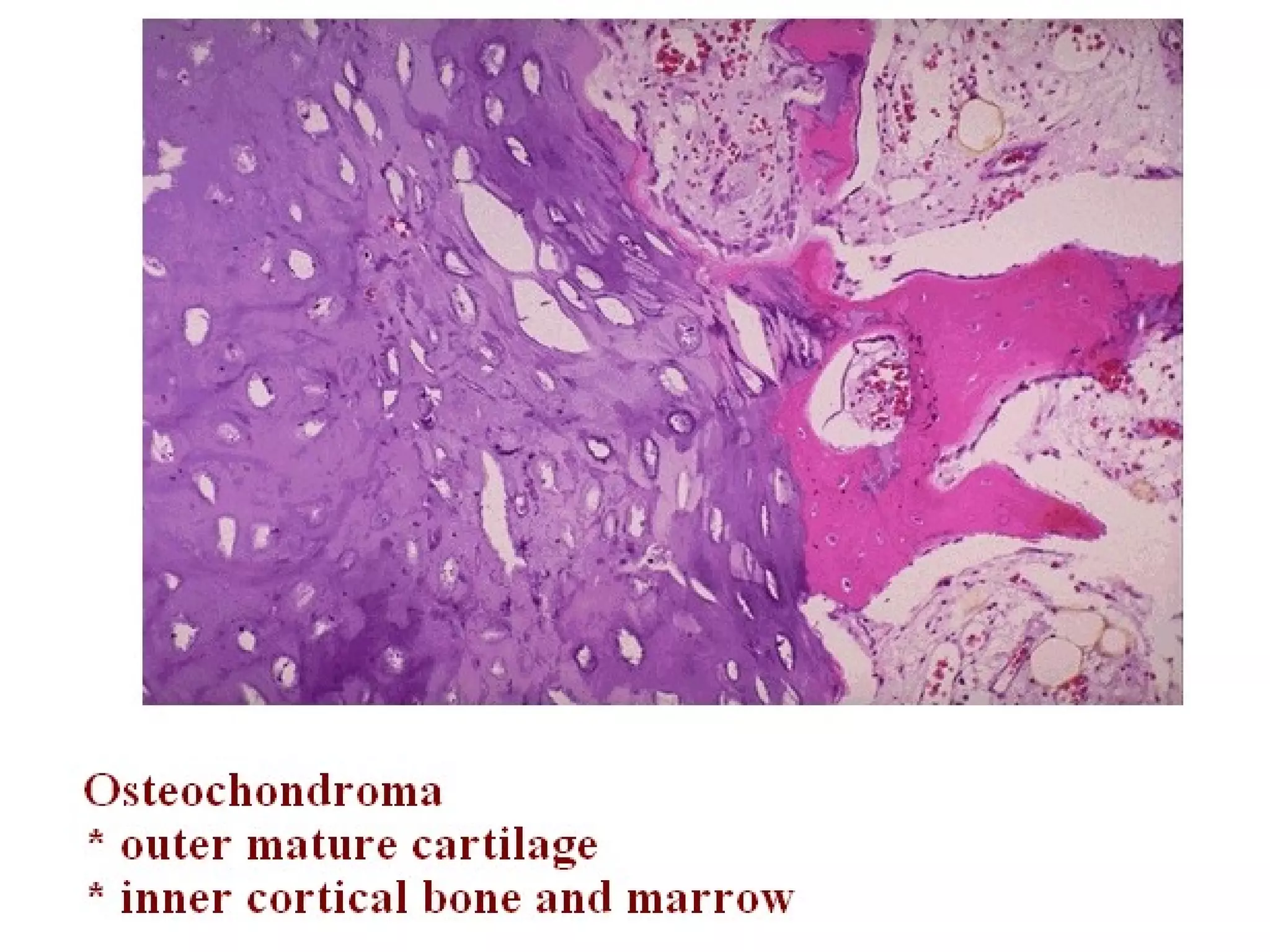 Osteochondroma | PPT