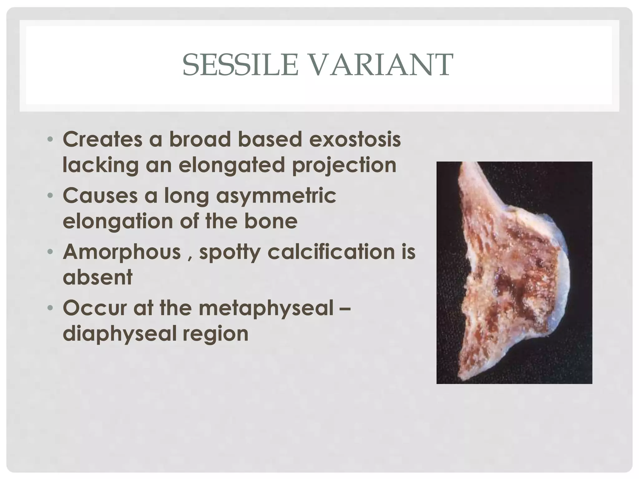 Osteochondroma | PPTX