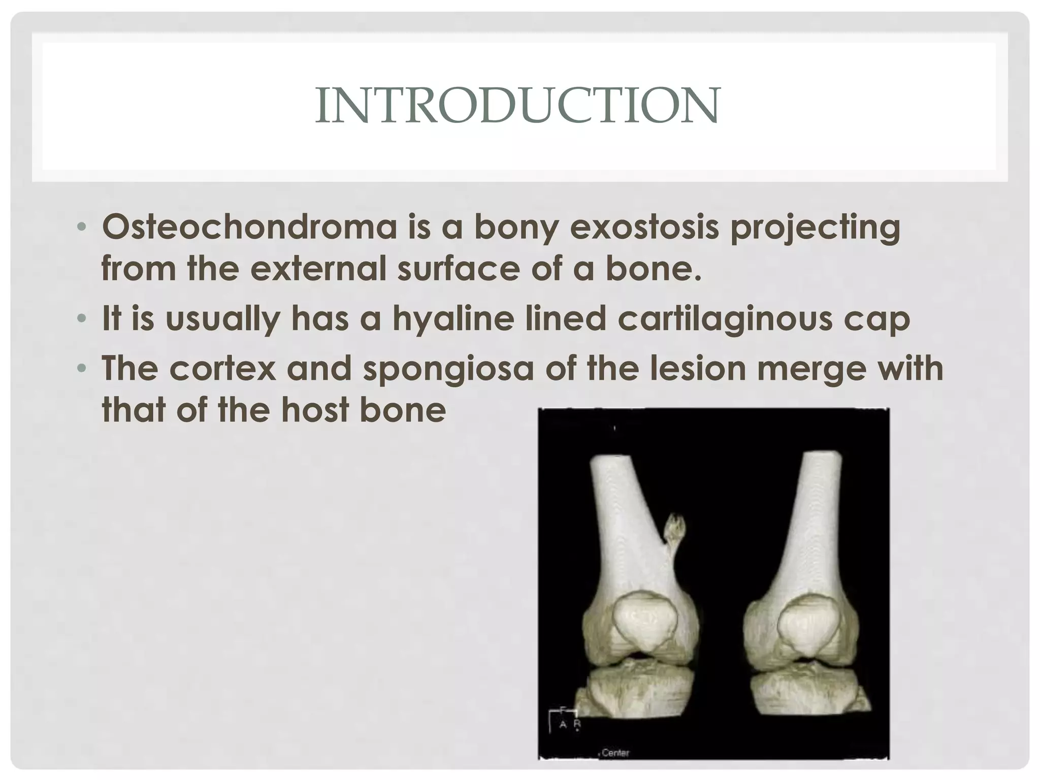 Osteochondroma | PPTX