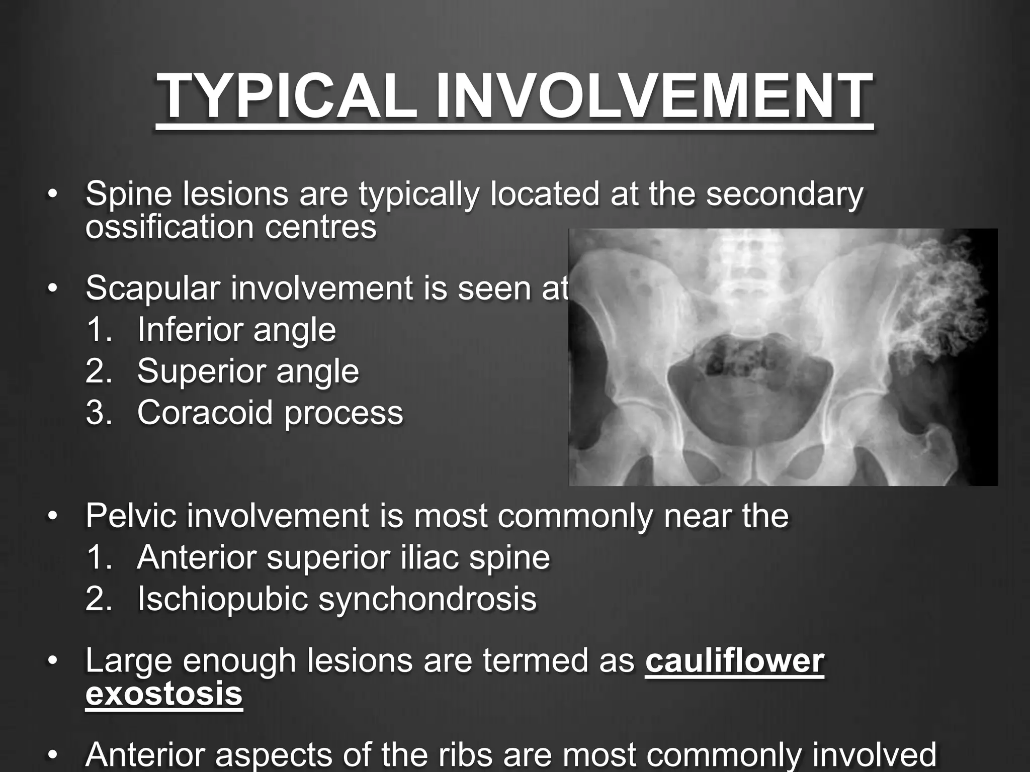 Osteochondroma (dr. mahesh) | PPTX