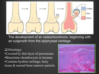 Osteochondroma (dr. mahesh) | PPTX