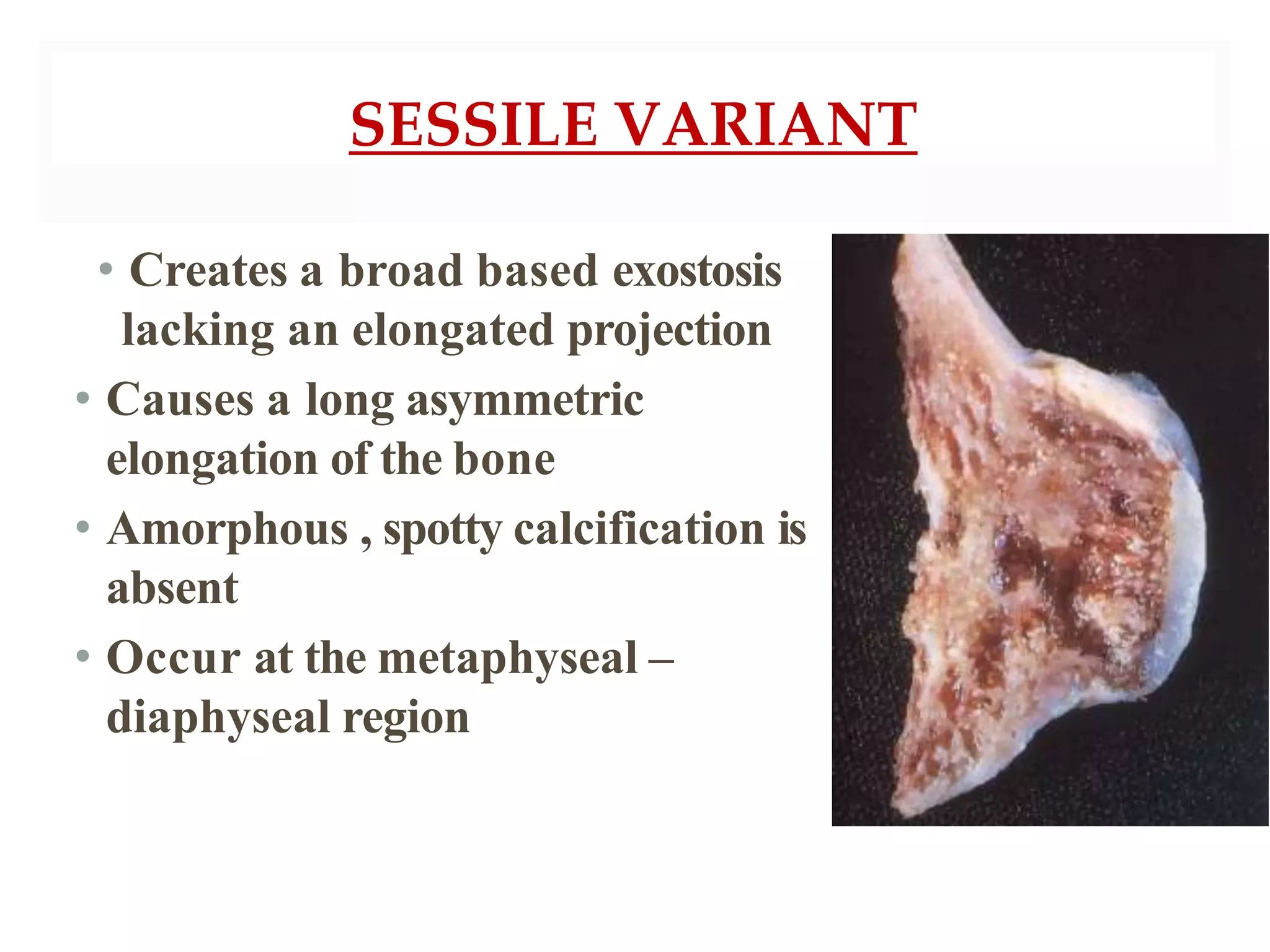 osteochondroma shubham.pptx