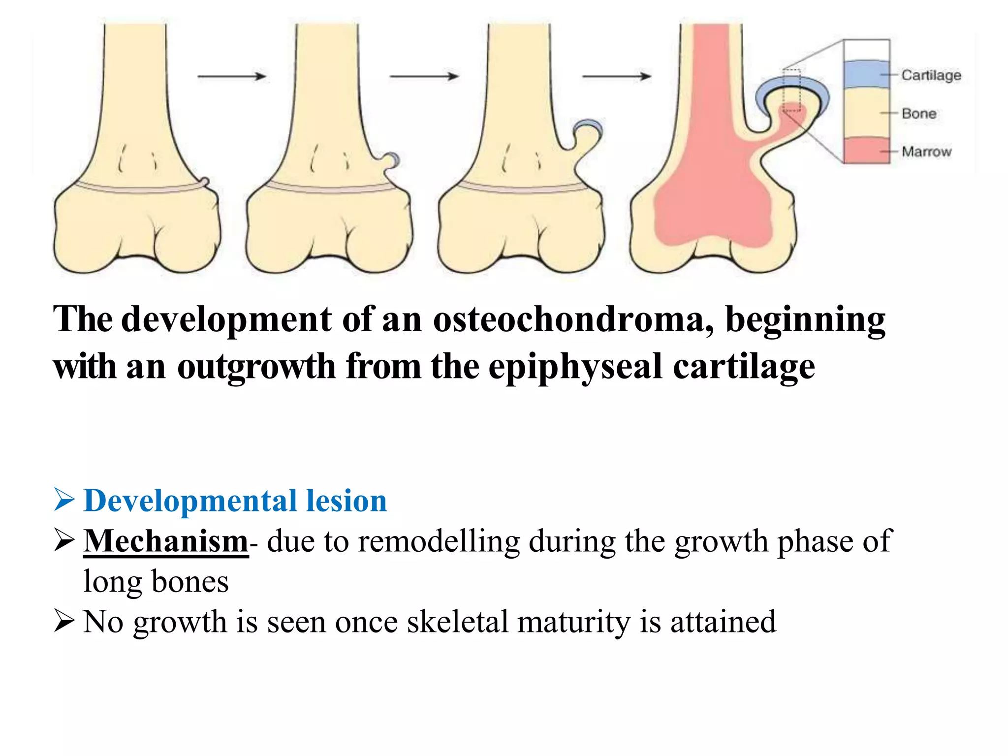 osteochondroma shubham.pptx