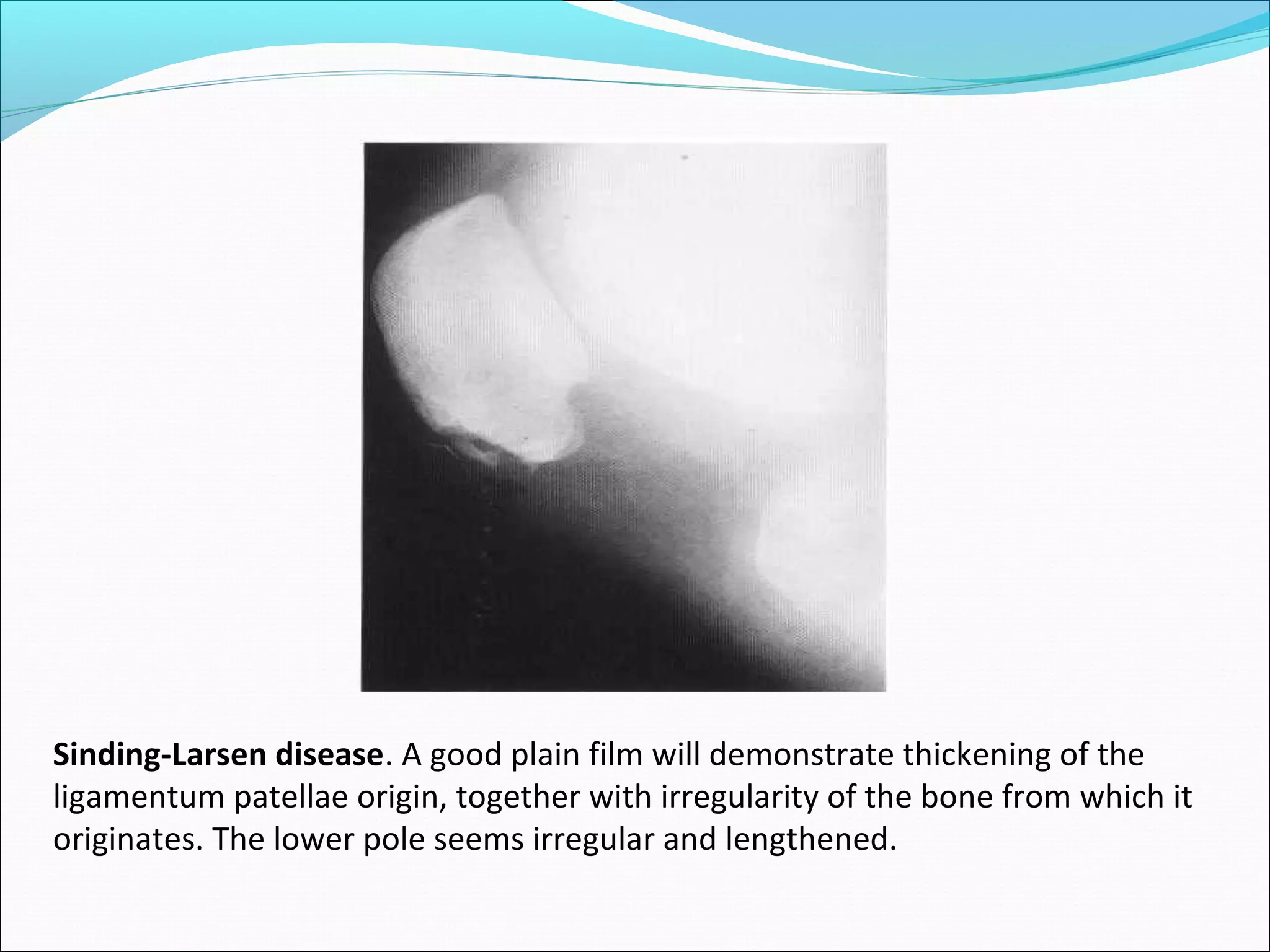 Osteochondrosis | PPT