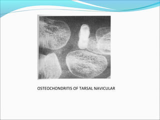 Osteochondrosis | PPT