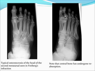 Osteochondrosis | PPT