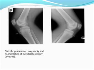 Osteochondrosis | PPT