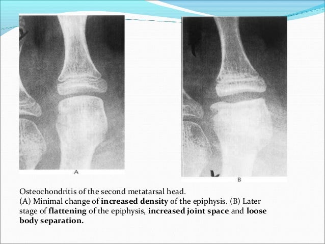 Osteochondrosis