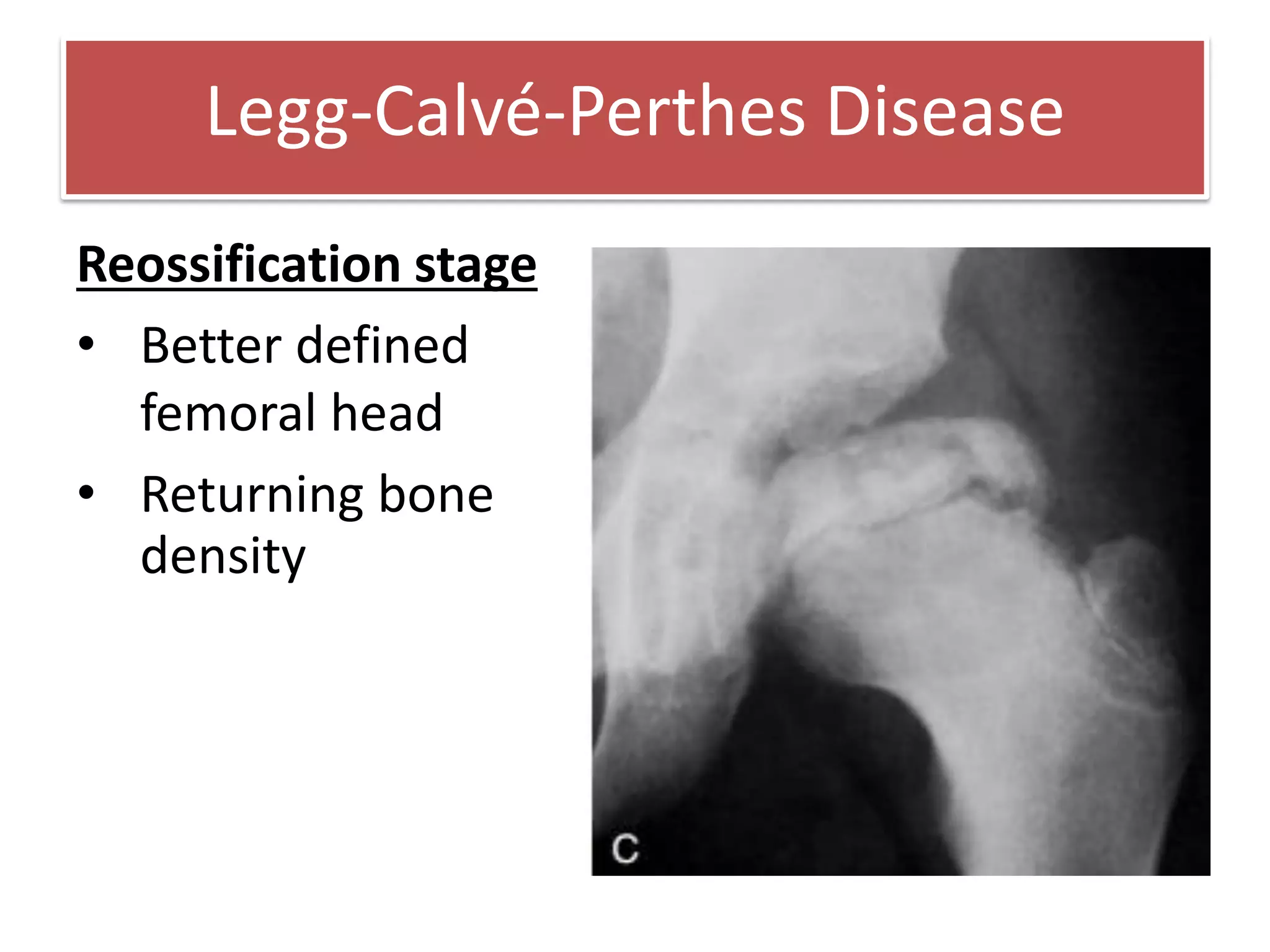 Osteochondrosis | PDF