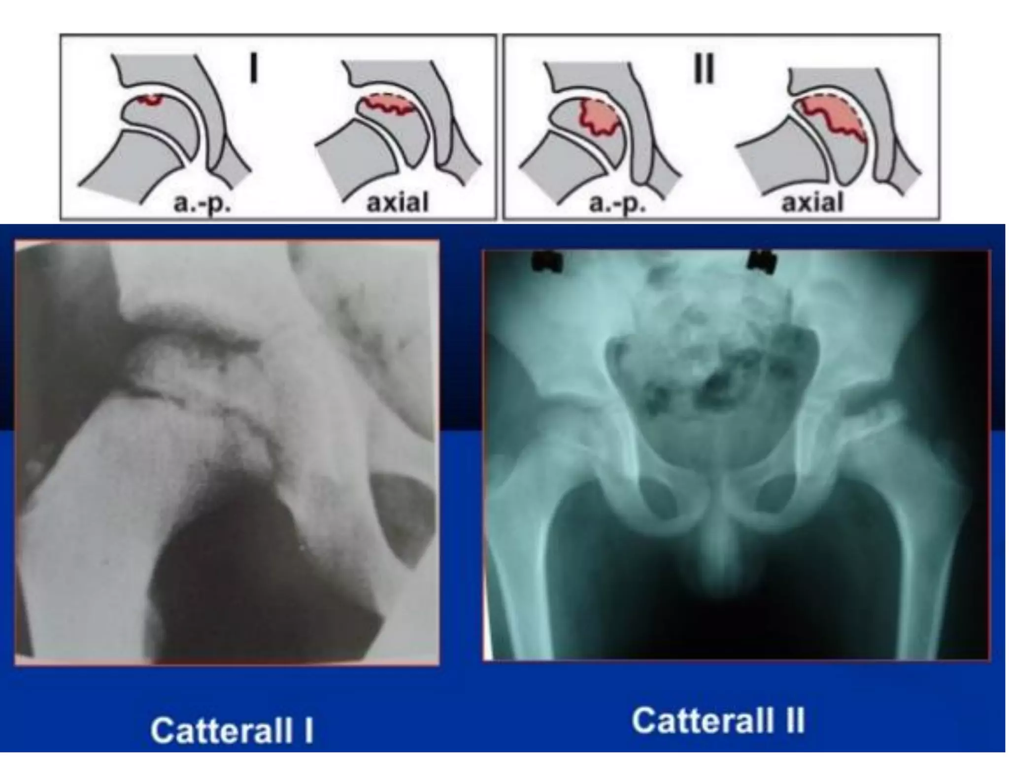 Osteochondrosis | PDF