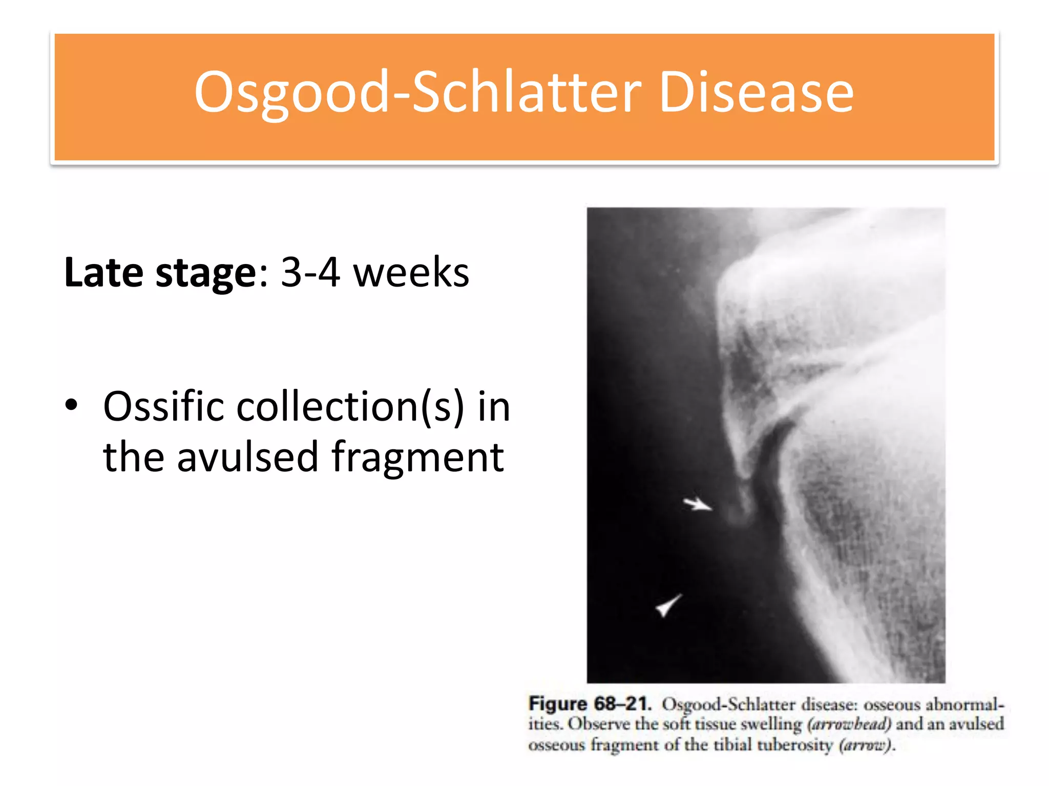 Osteochondrosis | PDF
