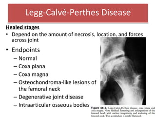 Osteochondrosis | PPT