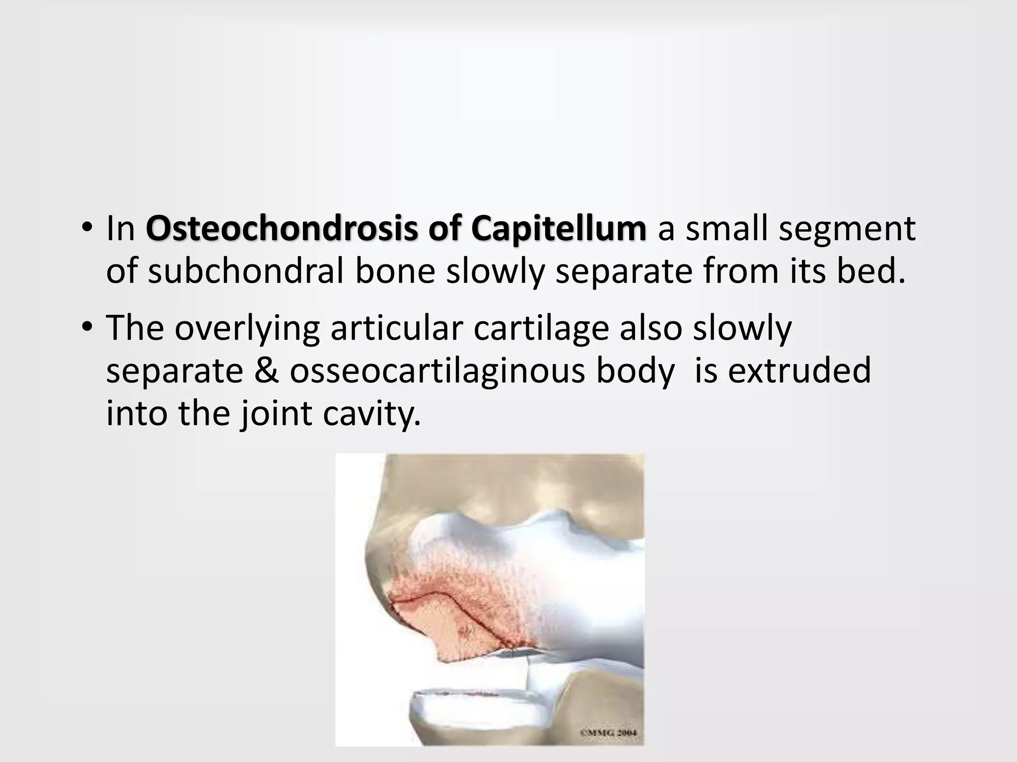 Osteochondrosis of capitellum | PPTX