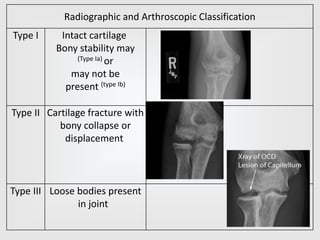 Osteochondrosis of capitellum | PPTX