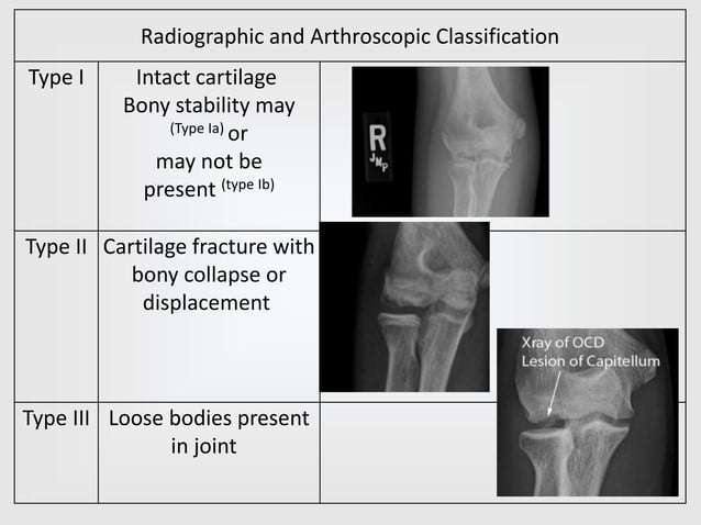 Osteochondrosis of capitellum | PPTX | Bone and Joint Conditions ...