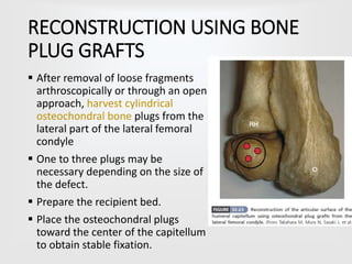 Osteochondrosis of capitellum | PPT