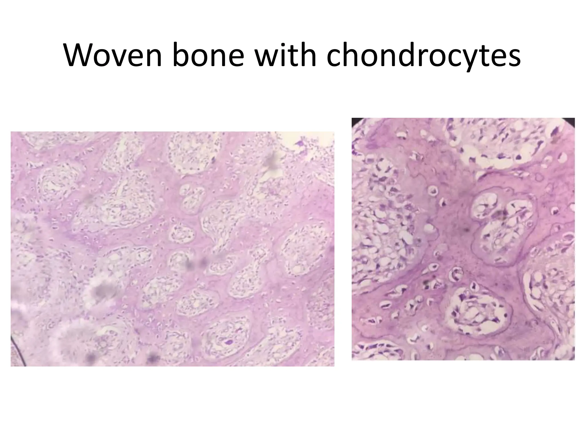 osteoclastoma.pptx with a wide description | PPTX