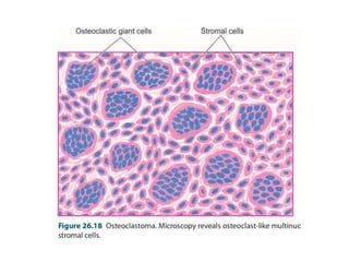 osteoclastoma.pptx with a wide description | PPT