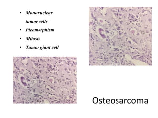 osteoclastoma.pptx with a wide description | PPT