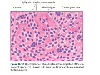 osteoclastoma.pptx with a wide description | PPT