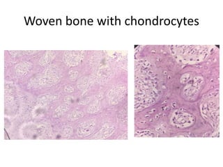 osteoclastoma.pptx with a wide description | PPT