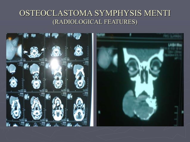 Osteoclastoma Symphysis Menti, A Case Report. | PPT | Bone and Joint ...