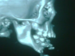 Osteoclastoma Symphysis Menti, A Case Report. | PPT | Bone and Joint ...