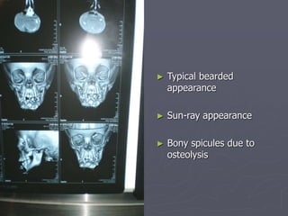 Osteoclastoma Symphysis Menti, A Case Report. | PPT | Bone and Joint ...