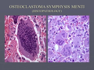 Osteoclastoma Symphysis Menti, A Case Report. | PPT | Bone and Joint ...