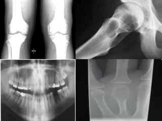 Osteoclastoma Symphysis Menti, A Case Report. | PPT | Bone and Joint ...