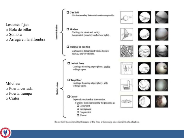 Osteocondritis disecante | PPTX