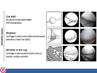 Osteocondritis disecante | PPTX