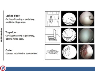 Osteocondritis disecante | PPTX