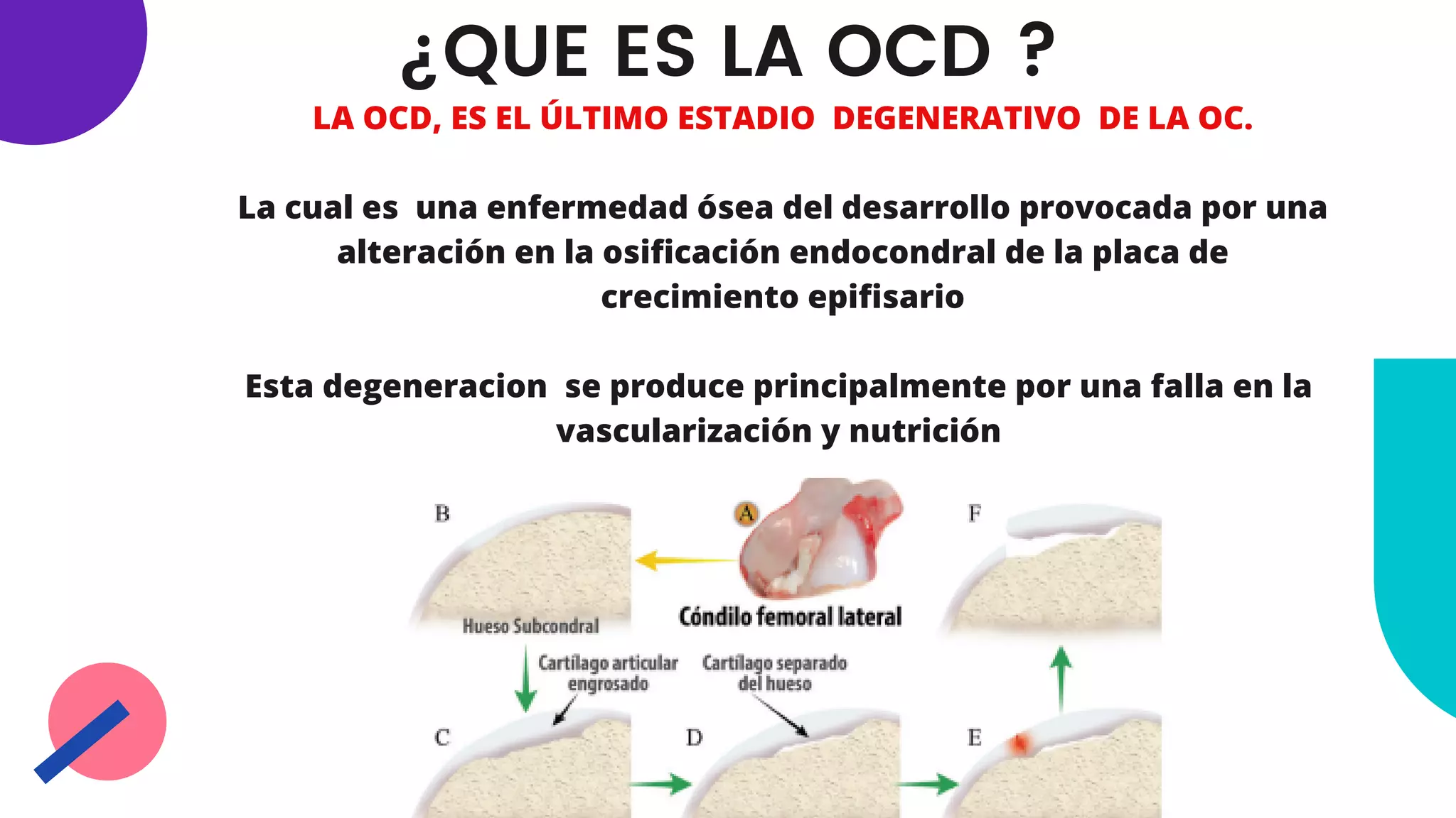 OSTEOCONDRITIS DISECANTE.pdf