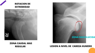 OSTEOCONDRITIS DISECANTE.pdf