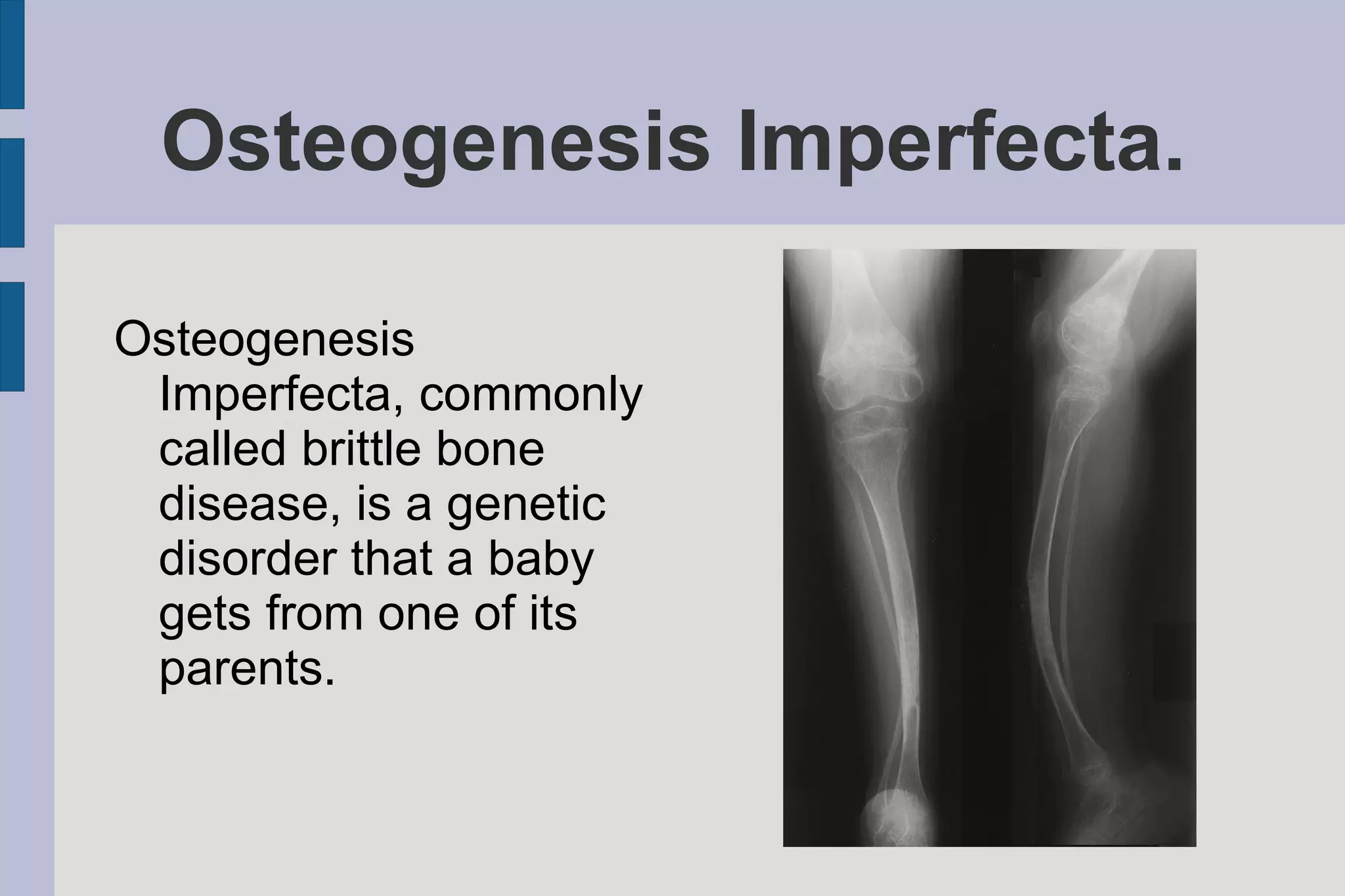 Osteogenesis imperfecta-3afranpancorbo@gmail.com